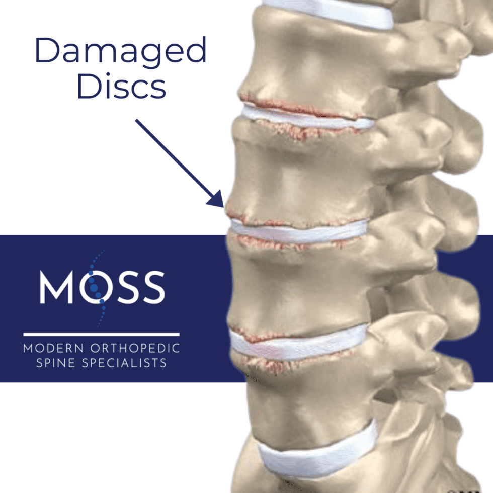 DEGENERATIVE DISC DISEASE AND TREATMENTS - Modern Orthopedic Spine ...