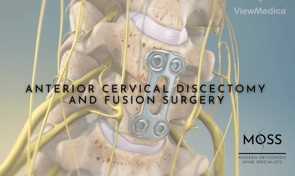 Anterior Cervical Discectomy & Fusion Surgery (ACDF) - Modern ...