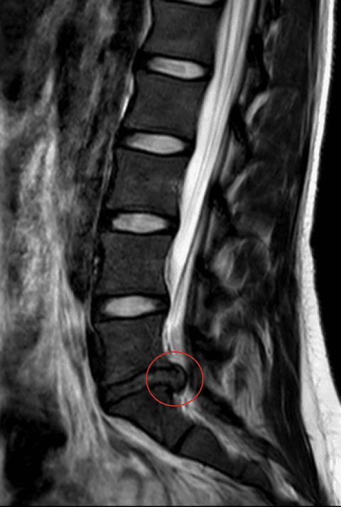 Nonsurgical Treatments for Lower Back Pain - Modern Orthopedic Spine ...